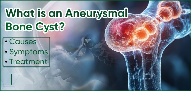 What is an Aneurysmal Bone Cyst? Causes, Symptoms, and Treatment